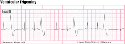 ECG Educator Blog : Six Second ECG Rhythm Strips