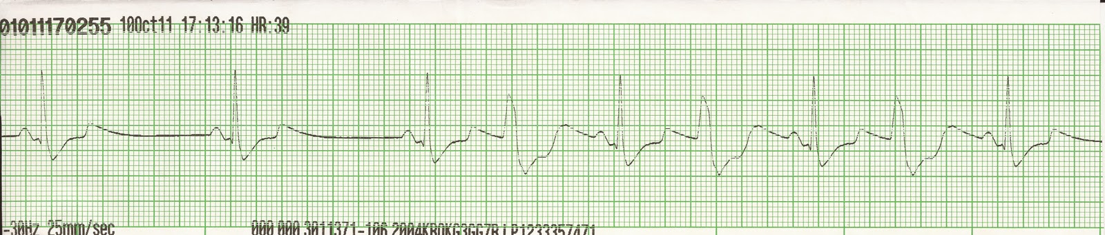 Float Nurse: EKG Rhythm Strips: Bigeminy, Trigeminy, Quadrageminy