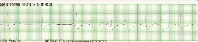 EKG Rhythm Strips: Bigeminy, Trigeminy, Quadrageminy