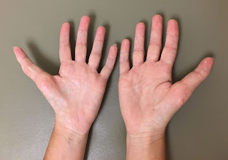 Families, Choices, and Untreated Triphalangeal Thumbs | Congenital Hand ...