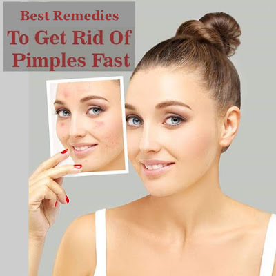 How to Get Rid of Pimples with Home Remedies