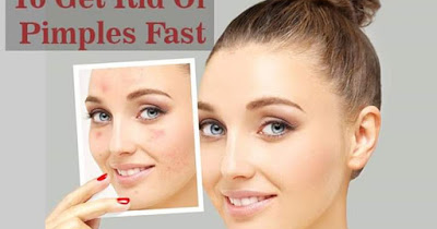 How to Get Rid of Pimples with Home Remedies