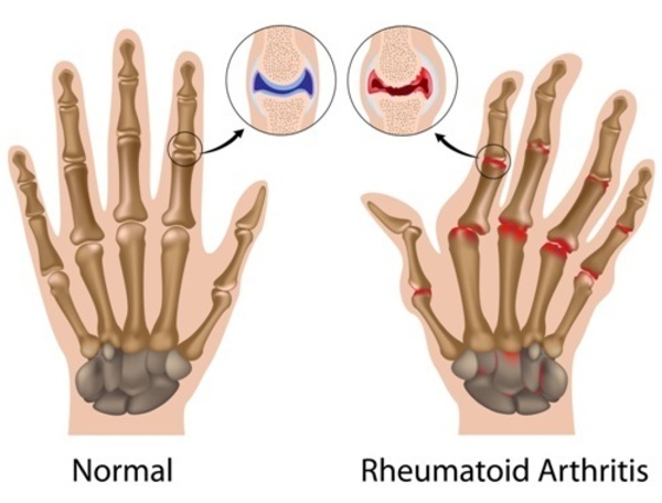 Systems of...: 8.- The Skeletal System - Diseases