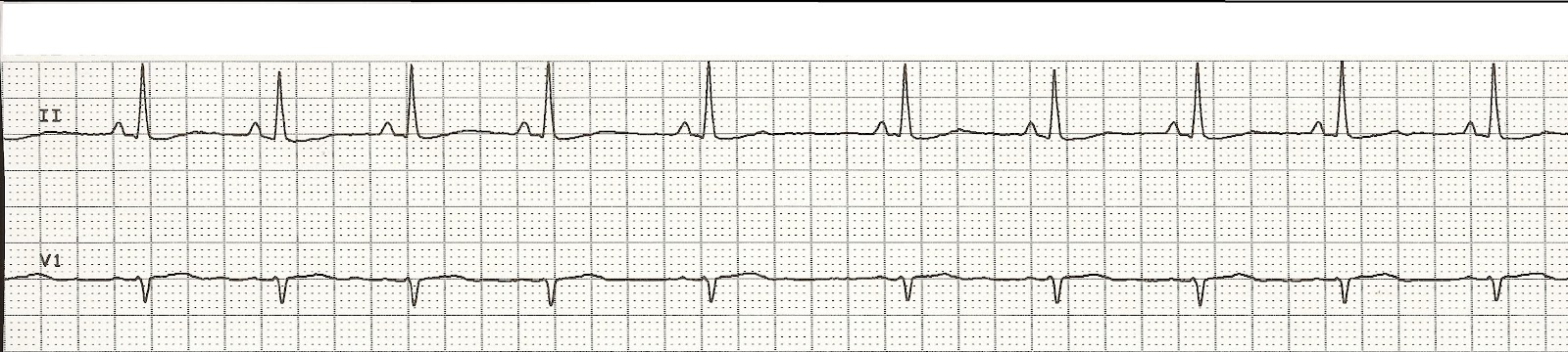 EKG Rhythm Strip Quiz 51: Sinus Rhythms
