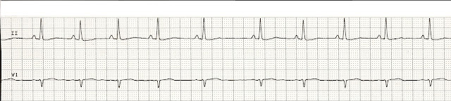 EKG Rhythm Strip Quiz 51: Sinus Rhythms