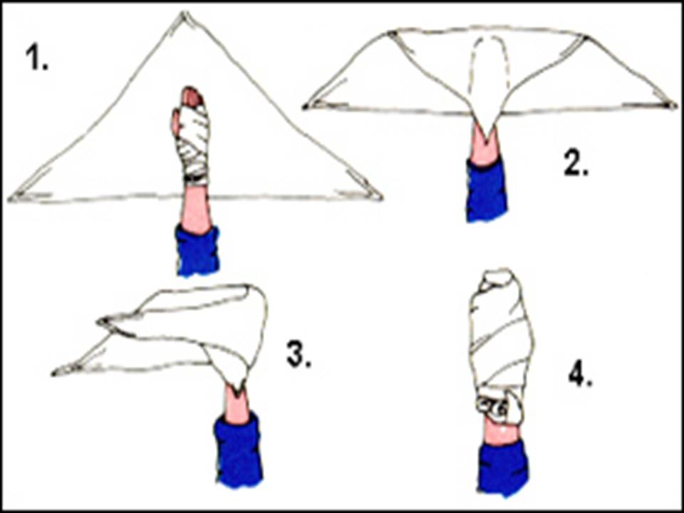 Patrulla Escorpion Tropa 822: Vendajes y sus usos