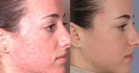 Natural Ways to Remove Acne Scars On Face Pockmark | acne