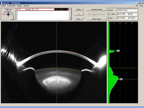 "Pentacam nuevo estudio ocular - MAXVISTA