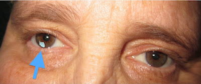 jm's Adventure with Multiple Myeloma: Relapsed High-Risk Myeloma ...