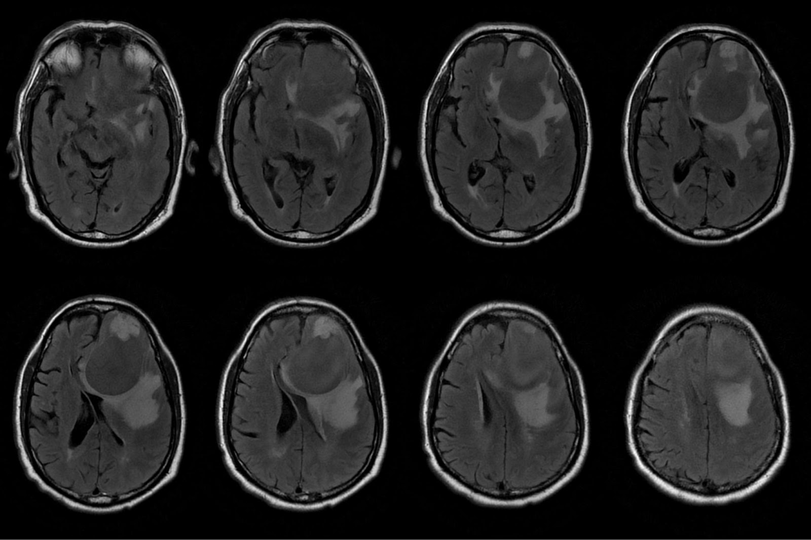 Dr Balaji Anvekar FRCR: Frontal SOL, Guess Histopathology