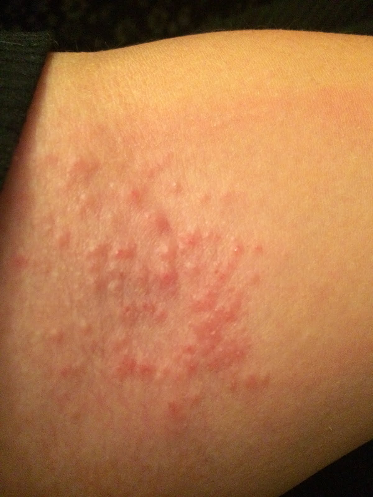 Fixing The Fat Girl's Future- My Journey with Cushing's Disease ...