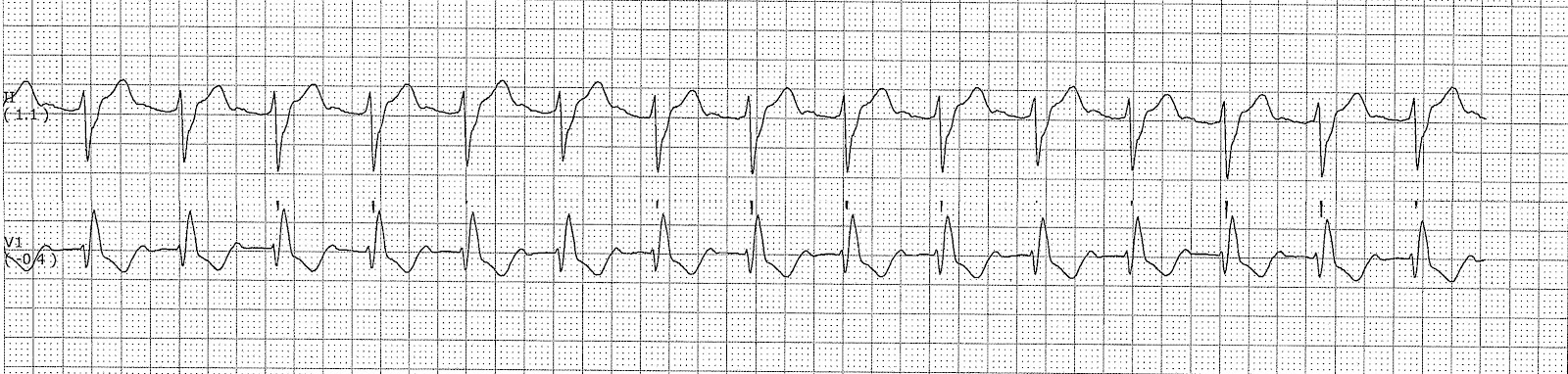 ECG Channel: Atrioventricular Block