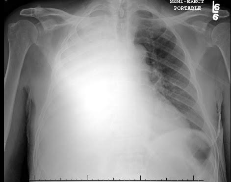 Emory Emergency Ultrasound: Complete White Out of the Right Lung