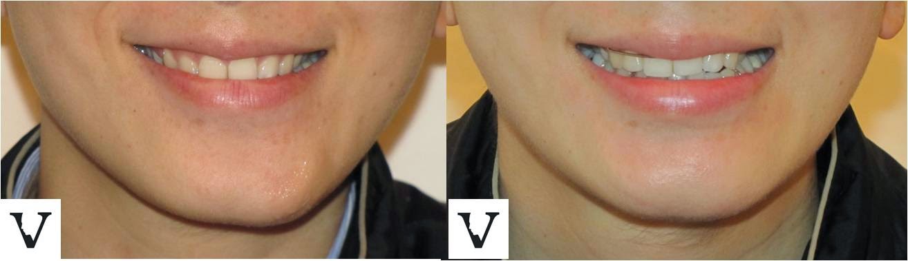 Boston Face Asymmetry correction without surgery, with Botox and ...
