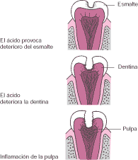 Pulpitis Aguda, Pulpitis Abscedosa, Pulpitis Serosa, Gangrena pulpar.