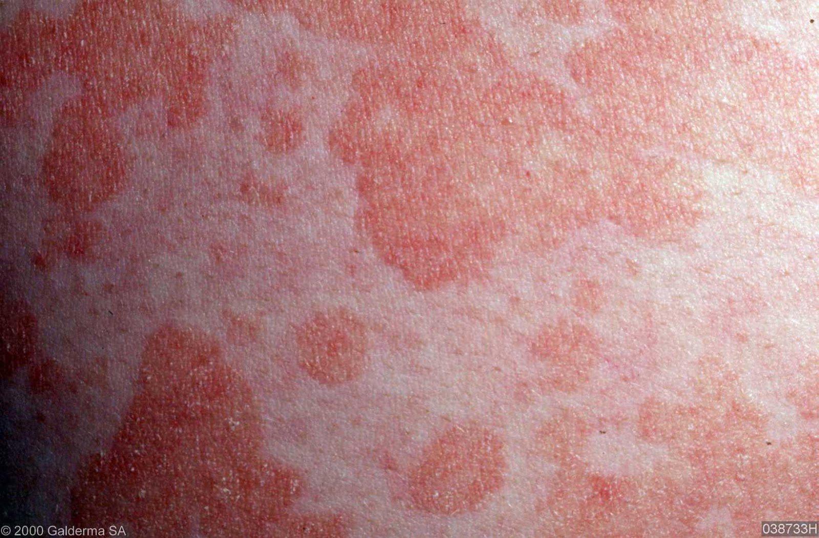 SKIN DISEASE TYPES: Tinea Versicolor