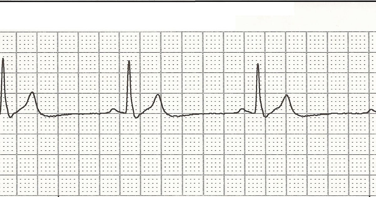 Float Nurse: Megacode PEA Part 1