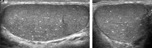 Primary Health Station Testicular Microlithiasis Can It Cause Cancer