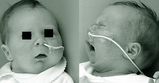 Síndrome de Pierre Robin ~ El Médico Contesta