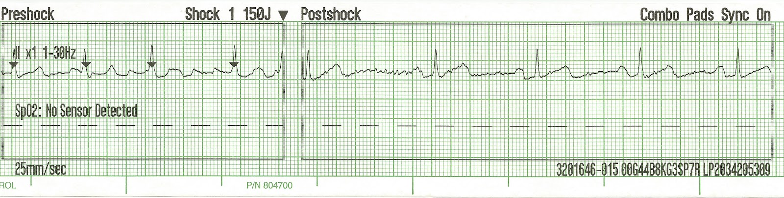 Cardioversion of Atrial Fibrillation