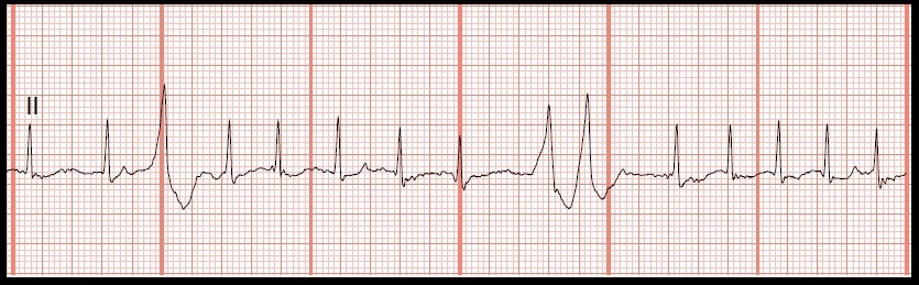 EKG Rhythm Strip Quiz 140