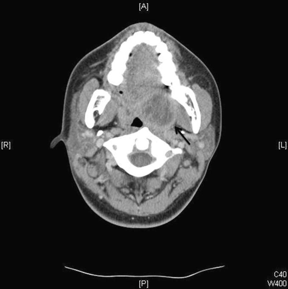 EmergenMed Health Blog: Características clínicas del absceso ...