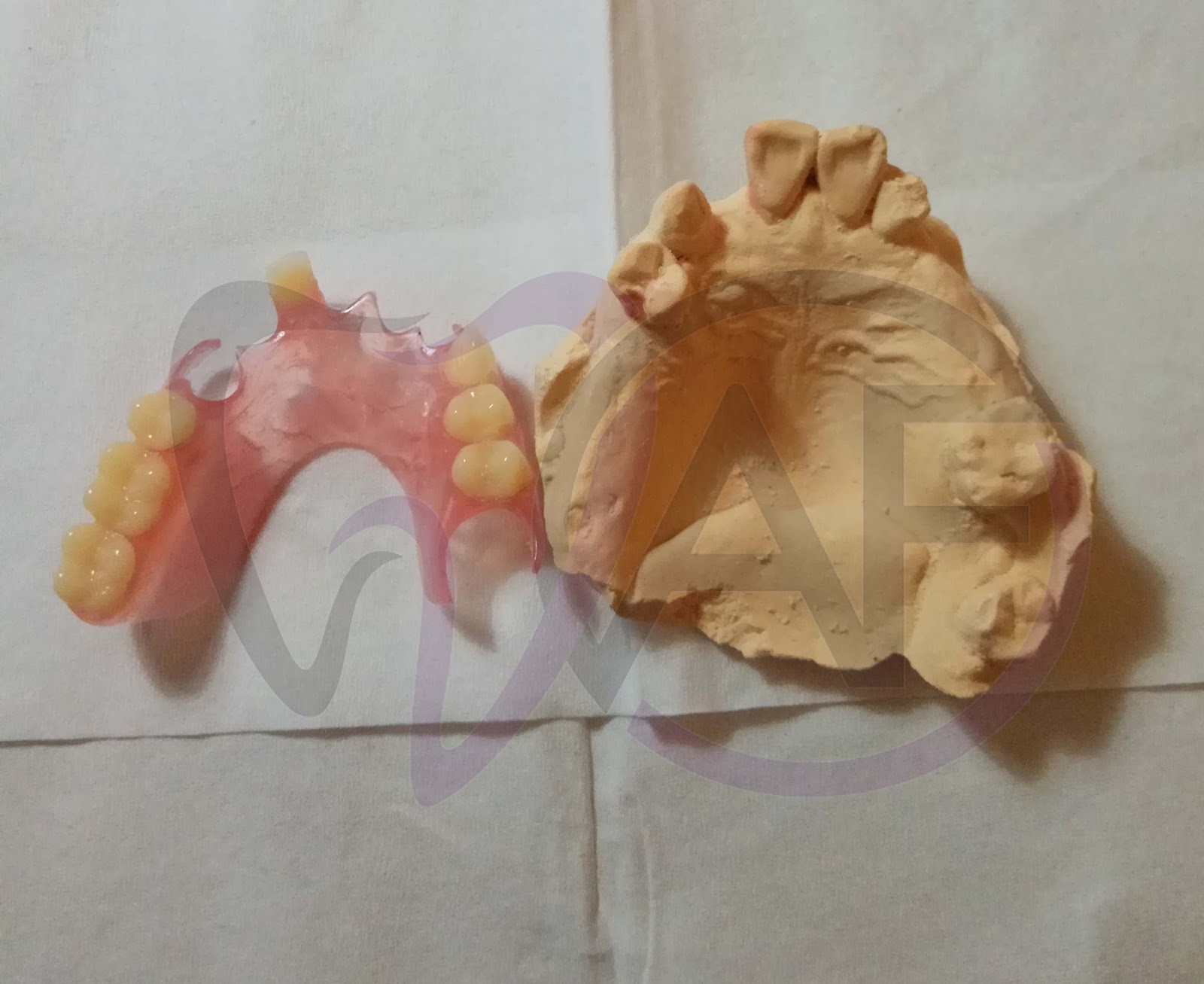 Gambar Tahap Pembuatan Gigi Palsu Fleksibel (Bukan Cara Pembuatan Gigi ...