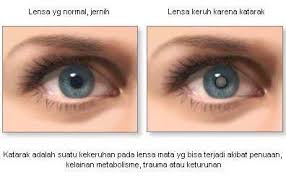 Bintik Putih Pada Lensa Mata Mulai Muncul
