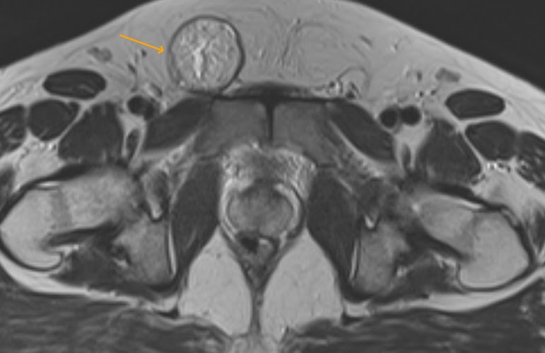 Mri Inguinal Hernia