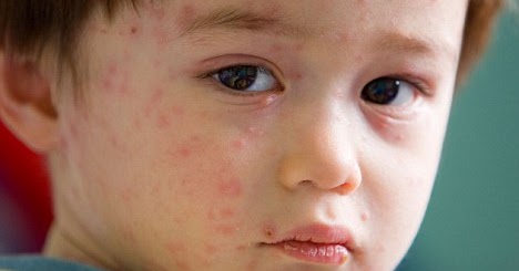 Cara Mengatasi Gabagen Sampai Benar-Benar Sembuh | Obat Luka Tersiram ...