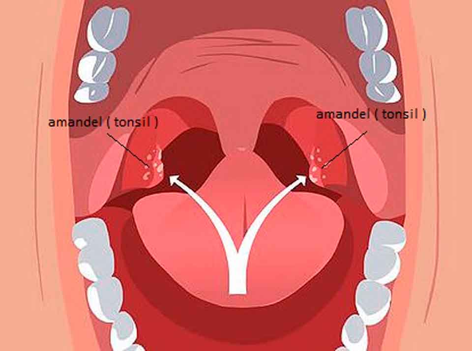 AMPUH...OBATI RADANG AMANDEL TANPA OPERASI DENGAN RAMUAN TRADISIONAL ...