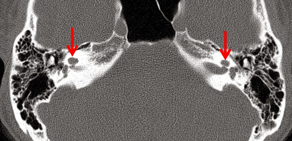 DISPLASIA DE MONDINI PDF