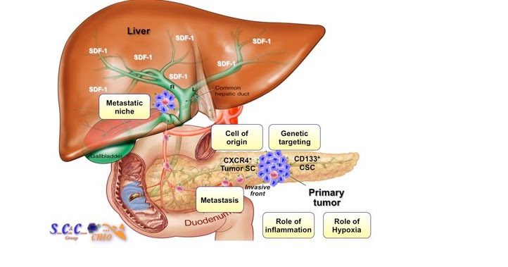 Warning Signs and Symptoms of Pancreatic Cancer - CancerOz