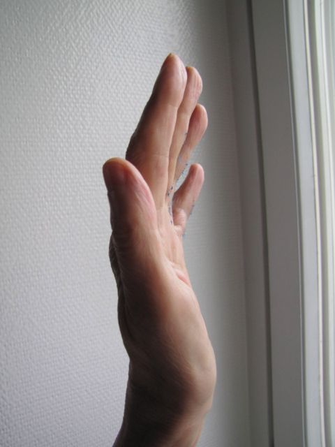 Handrehabilitationcase with Dupuytren's contracture.: A trauma in the ...