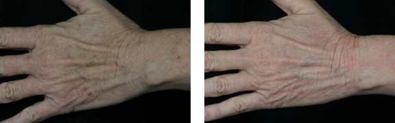 6 amazing hand rejuvenation photos