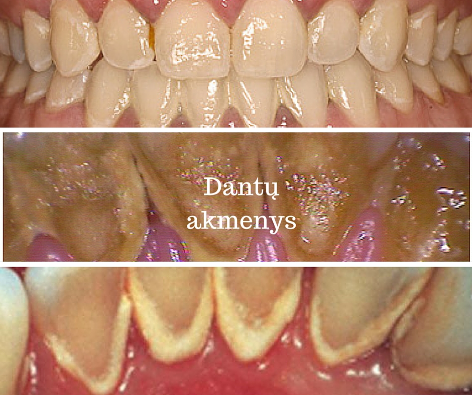 kaip išsaugoti sveikus dantis: Dantų akmenys