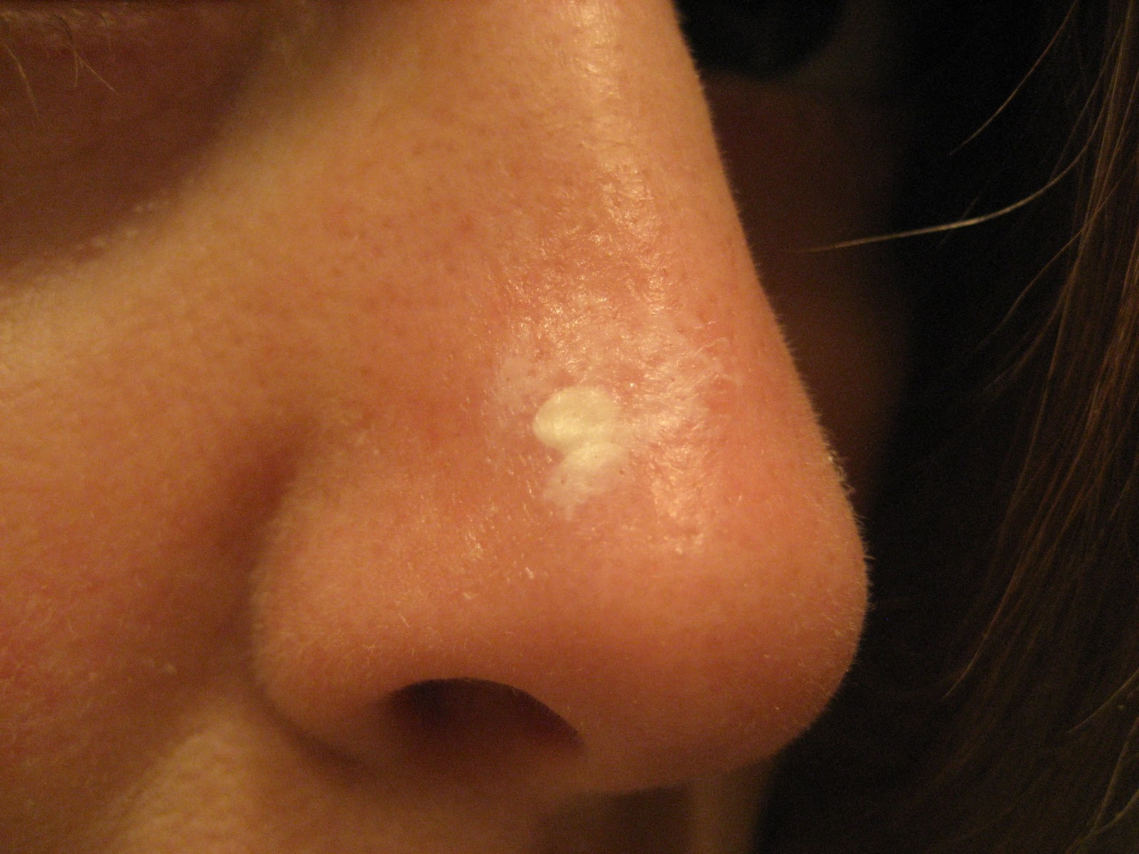 Chemical Peels for Acne and Anti Aging: Complete Mole Removal with TCA ...