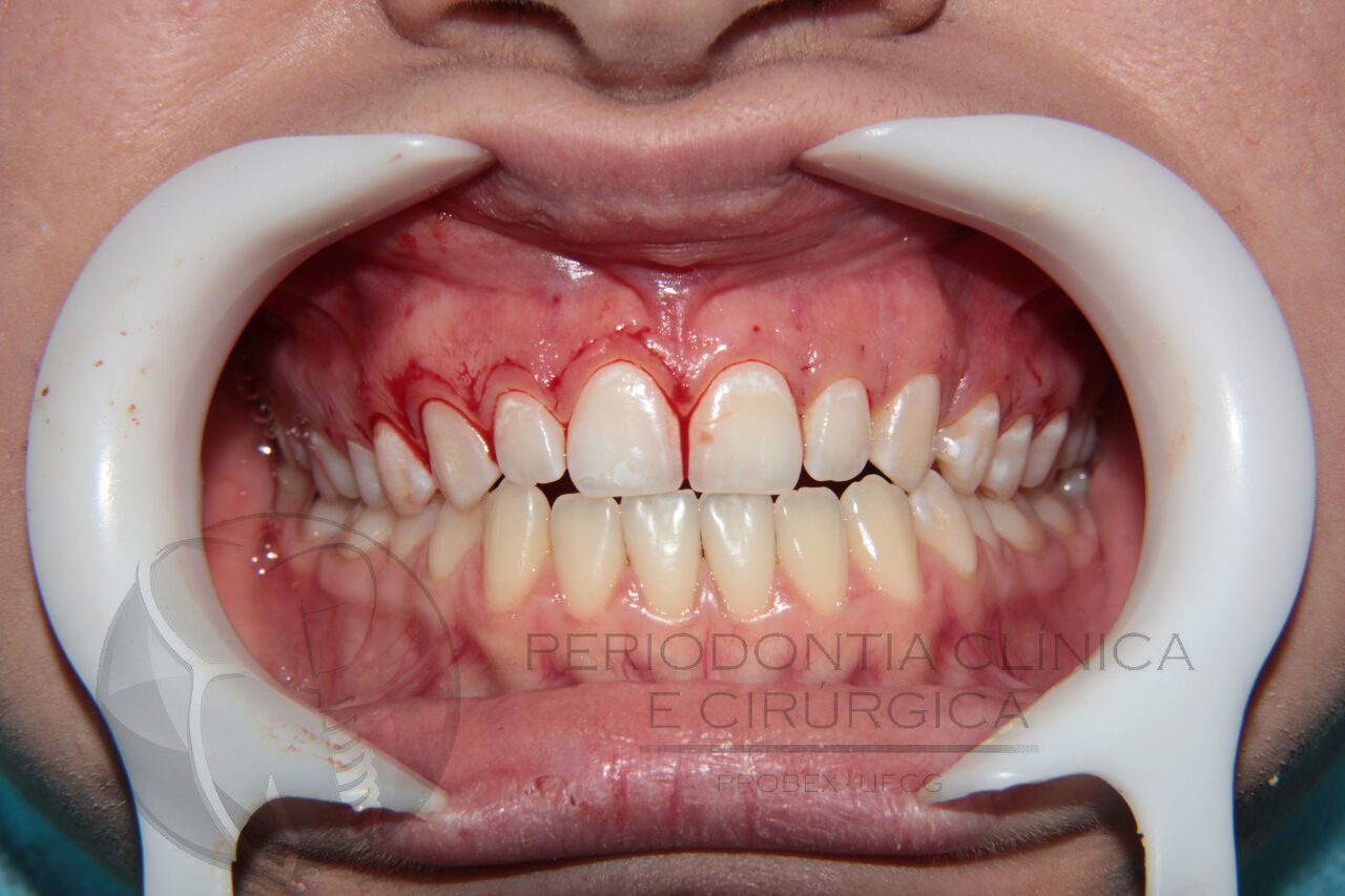 GENGIVECTOMIA EM BISEL INTERNO PARA CORREÇÃO DE SORRISO GENGIVAL