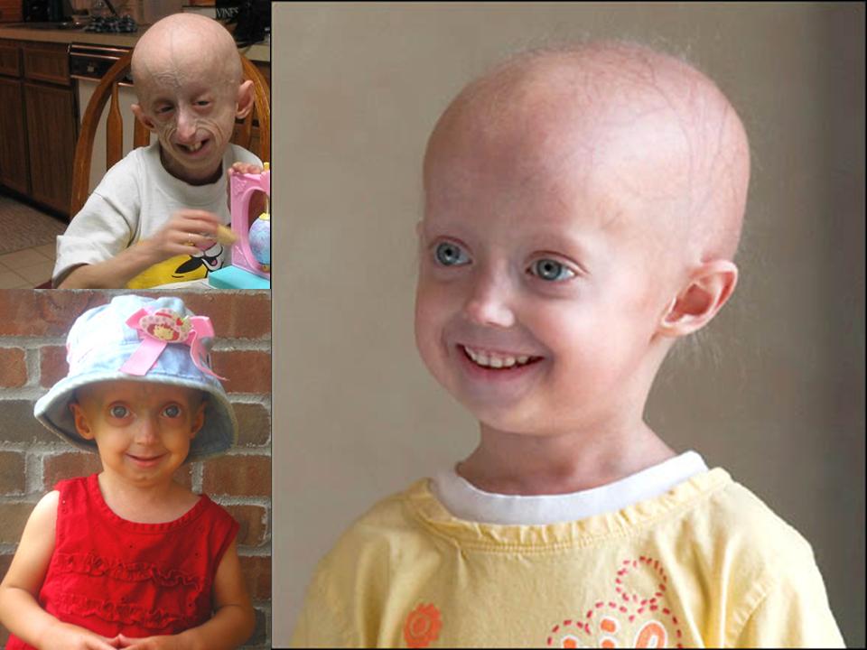 progeria syndrome ~ Christine O'Donnell