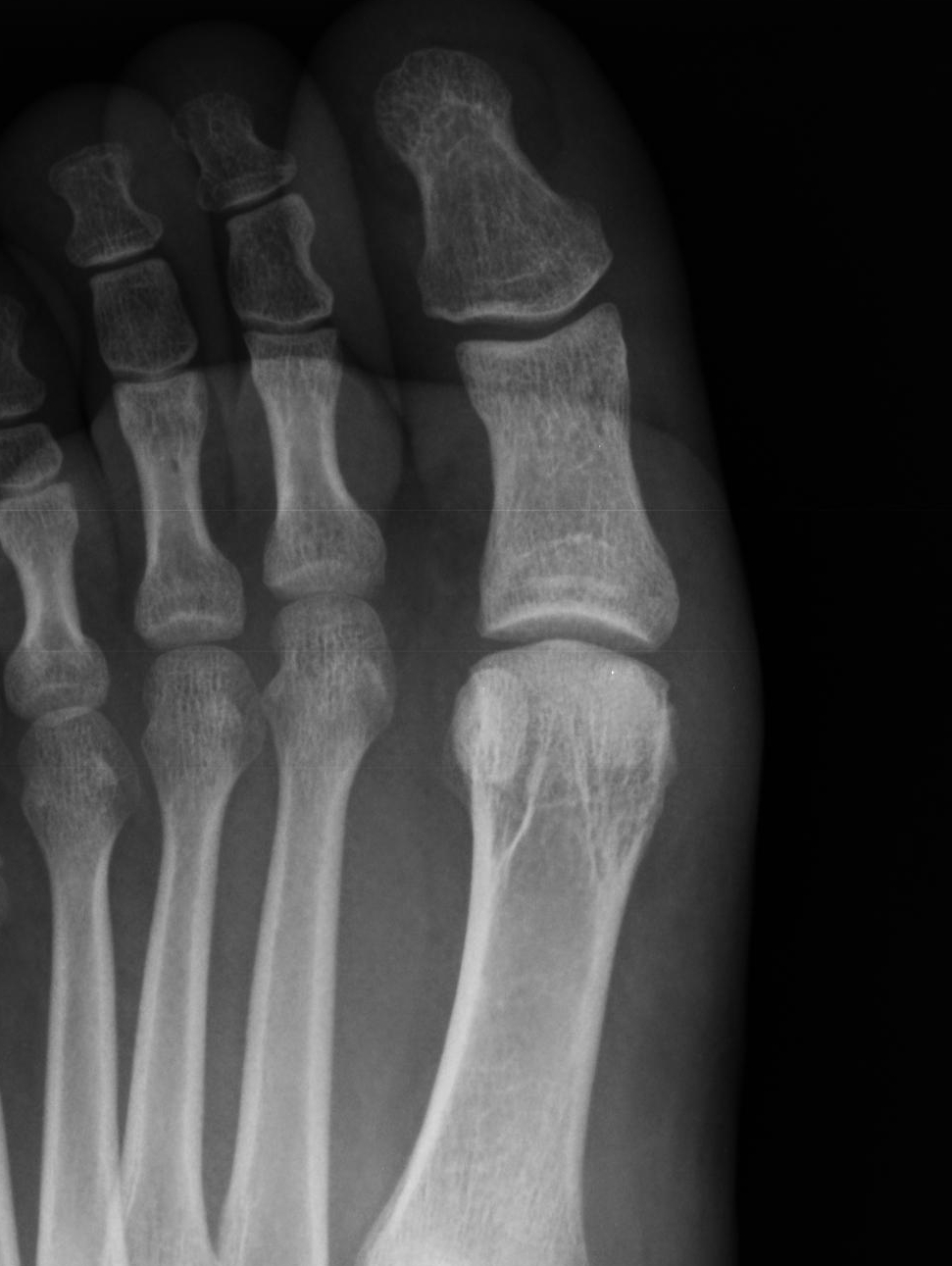 O Radiologista: Artrite por Gota - Ultrassonografia