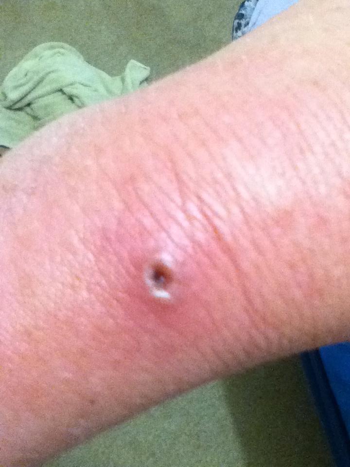 roonie's blog: Australian Spider Bite: A Trip to Royal Perth Hospital