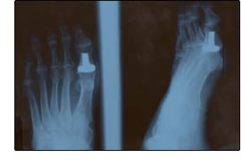 Podo Basas al Día: HALLUX LIMITUS. IMPLANTE BIOPRO. BRAQUIMETATARSIA ...