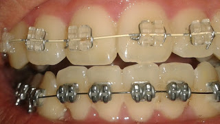 Mi ortodoncia paso a paso y más: Primeros cambios,,,,