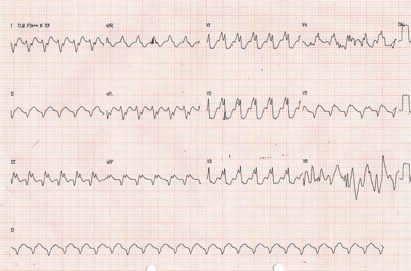 Taquicardia supraventricular