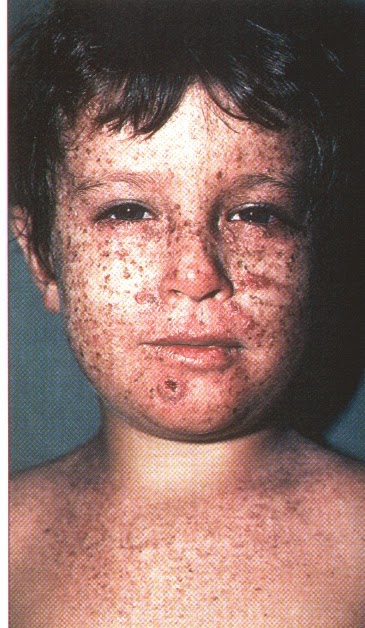 ENFERMEDADES NO MUY CONOCIDAS : XERODERMIA PIGMENTOSA