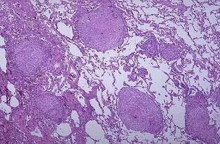 DESTINO MEDICO: MICROSCOPIO VIRTUAL PATOLOGIA PULMONAR, TBC PULMONAR