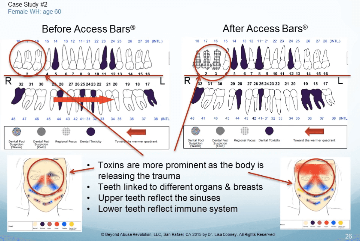 Barras de Access Curitiba: Barras de Access Consciousness™ sem segredos