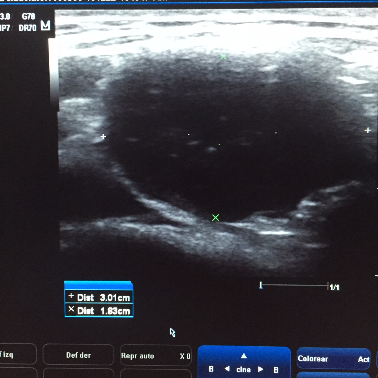 Ecografía de los ganglios linfáticos