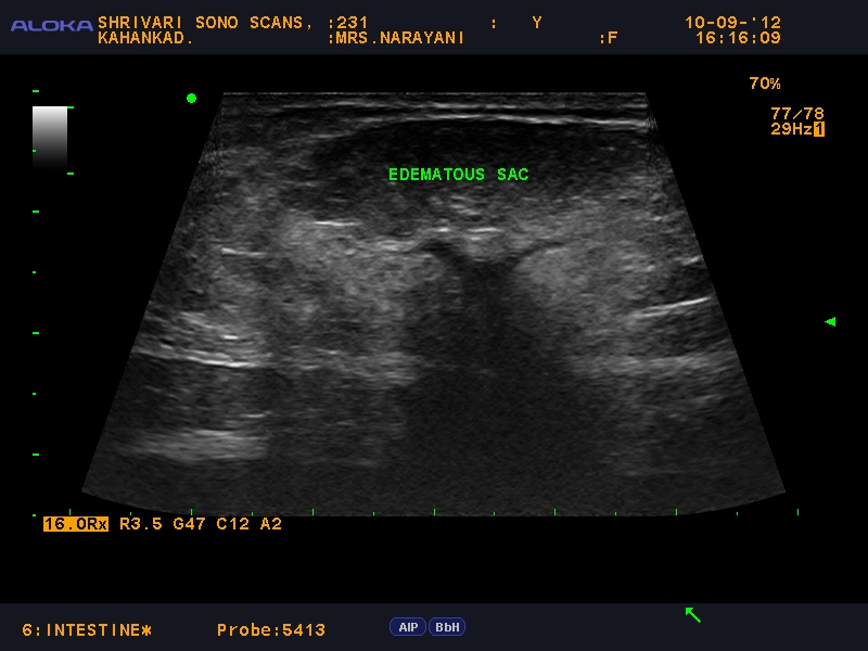 Shrivari Sono Scans: Ventral Hernia with obstruction-(ventral hernia ...