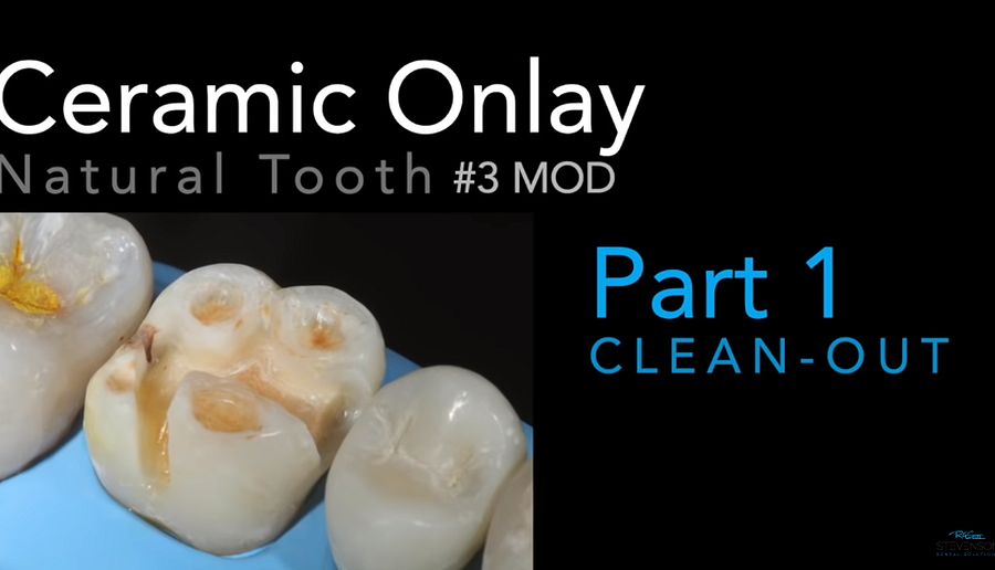 CLINICAL CASE: Ceramic Onlay Part 1 (Clean-out)